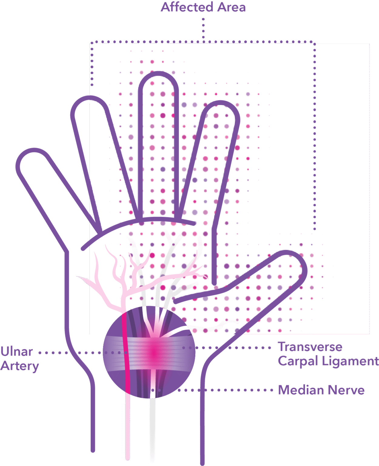 Carpal Tunnel Syndrome: Symptoms and Treatment
