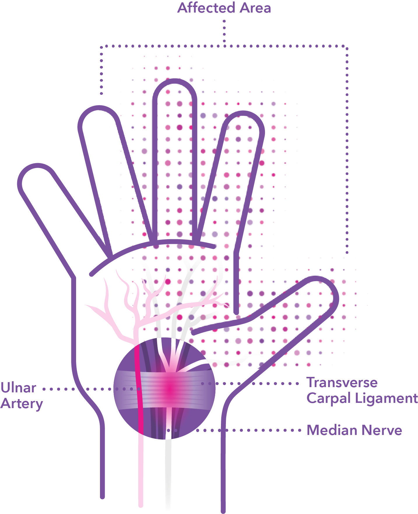 Carpal Tunnel Syndrome: Symptoms and Treatment
