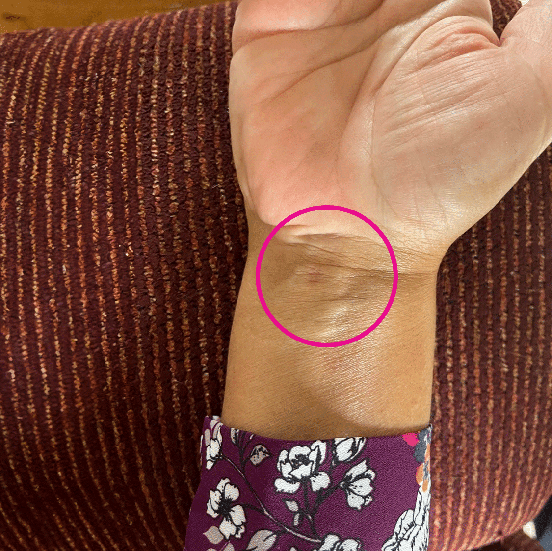 Dr. William Feinstein - Cure My Carpal Tunnel